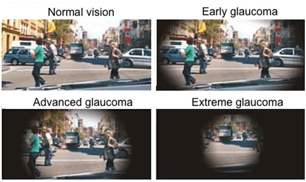 What is Glaucoma? | Bellaire Family Eye Care